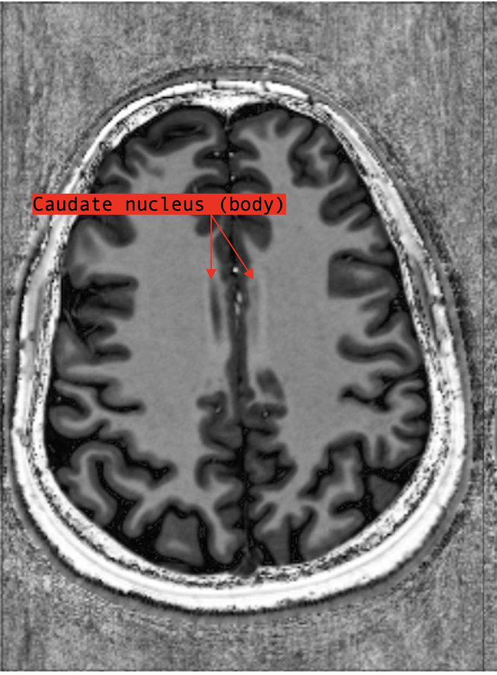 Basal Ganglia - Normal Brain MRI