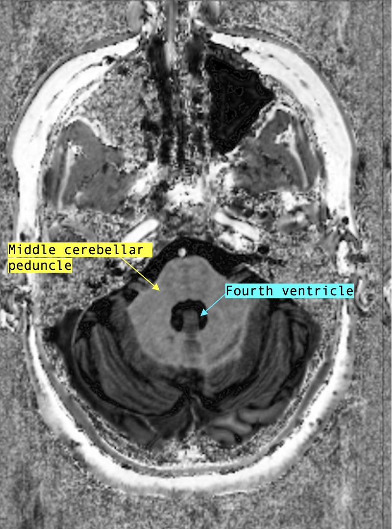 Posterior Fossa Structures - Normal Brain MRI