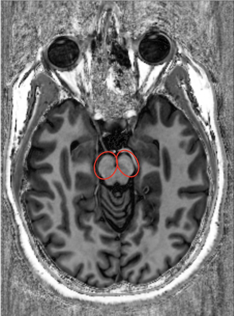 Posterior Fossa Structures - Normal Brain MRI