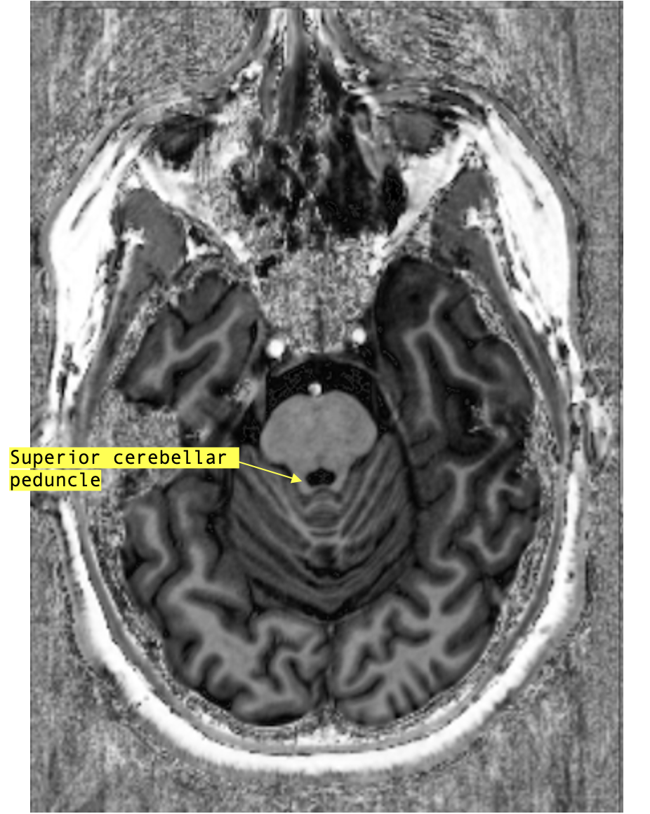 Posterior Fossa Structures - Normal Brain MRI