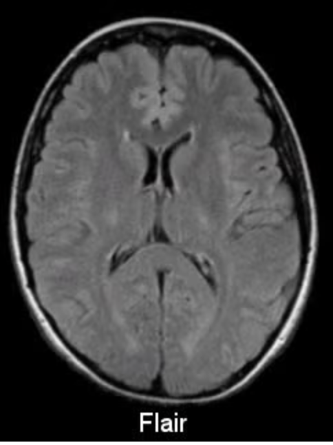 Grey and White Matter - Normal Brain MRI
